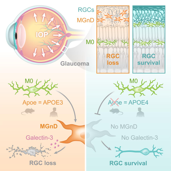 Graphical abstract for ophthalmology research from the collection of ...