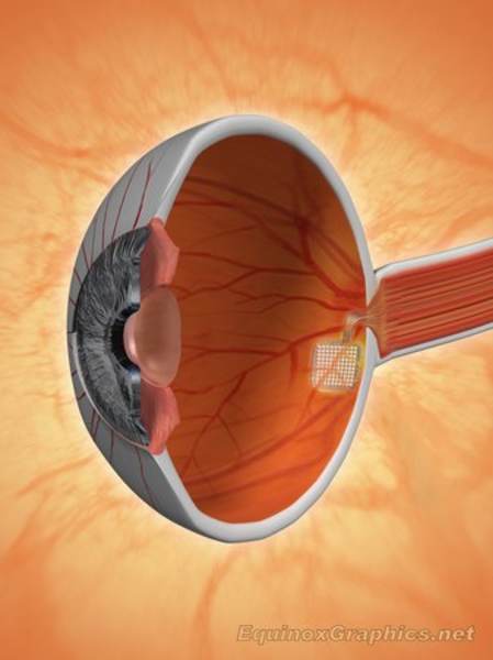 Retina Implant (bionic eye) from the collection of Guild of Natural ...